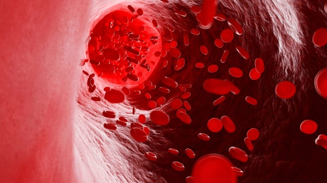 How effective will the move of fortifying Rice with Iron in reducing ...